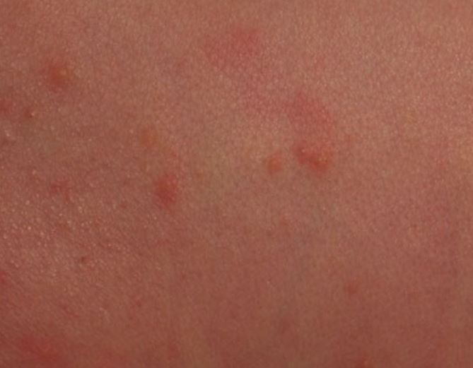 Newborn Rashes: Pa(i)ge the Pediatrician! - Potomac Pediatrics