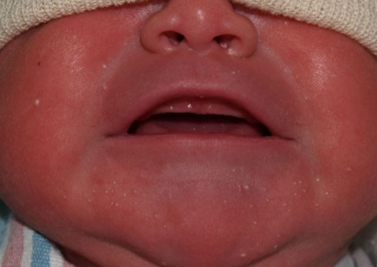 Newborn Rashes: Pa(i)ge the Pediatrician! - Potomac Pediatrics