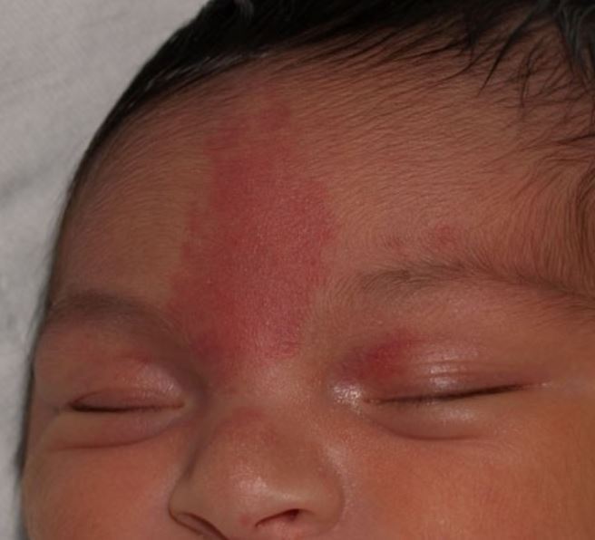 Newborn Rashes: Pa(i)ge the Pediatrician! - Potomac Pediatrics